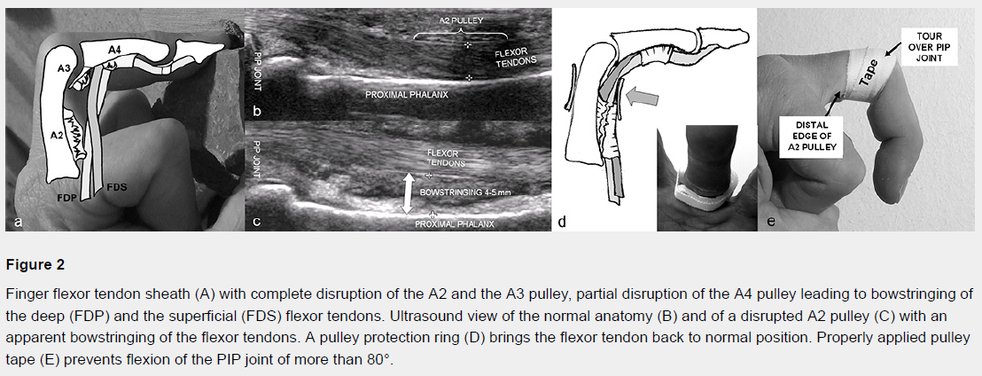 Using a “pulley splint” to support your finger – The Beta Angel Project